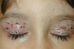 National Fabry Disease Foundation - Fabry Disease Skin Symptoms