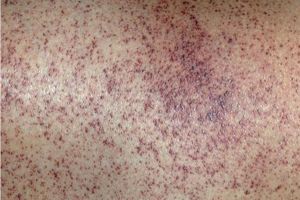 National Fabry Disease Foundation - Fabry Disease Skin Symptoms