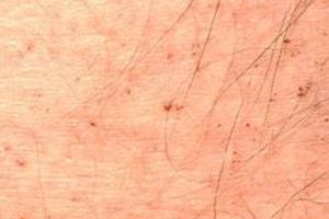 National Fabry Disease Foundation - Fabry Disease Skin Symptoms