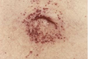 National Fabry Disease Foundation - General