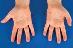National Fabry Disease Foundation - Fabry Disease Skin Symptoms