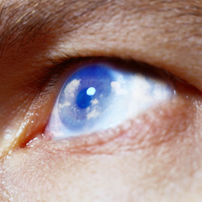 National Fabry Disease Foundation - Fabry Disease Eye Symptoms